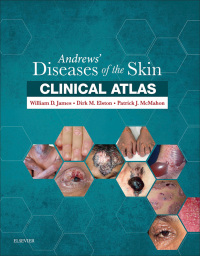 Andrews' Diseases of the Skin Clinical Atlas - Electronic 1st edition ...